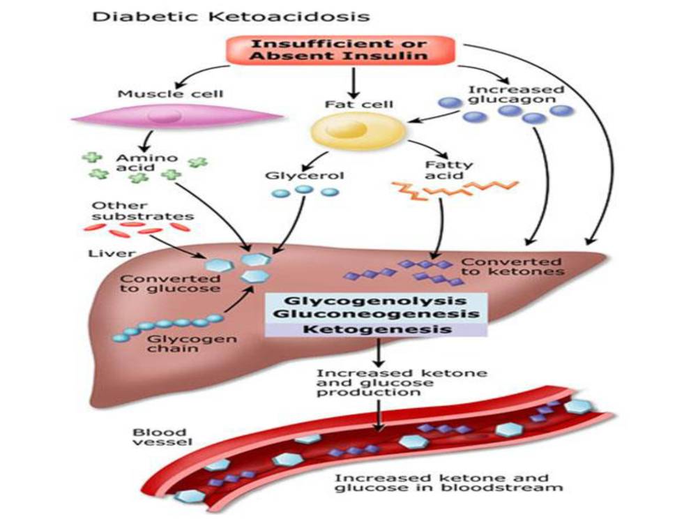 Diabetic Ketoacidosis (DKA) - PowerPoint Slides - MyPrivateTutor Malaysia
